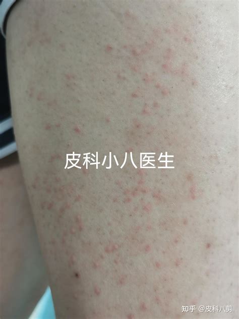 皮科小八医生激光脱毛需要做多少次 知乎