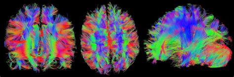 Challenges In Interpreting Dti Data Society For Brain Mapping And