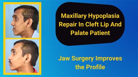 Maxillary Hypoplasia