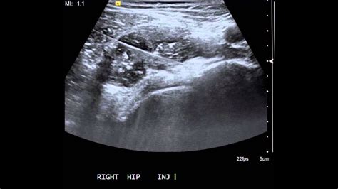 Iliopsoas Bursitis Injection