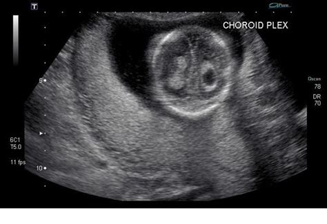 Choroid Plexus Ultrasound