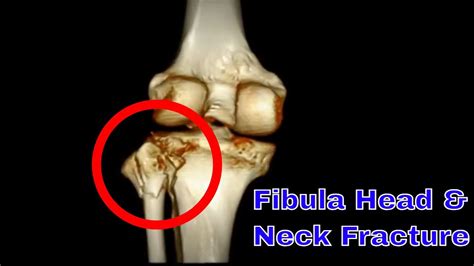 Fibular Head Avulsion Fracture