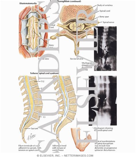 Spinal Dysraphism Spina Bifida Status Dysraphicus Rachischisis