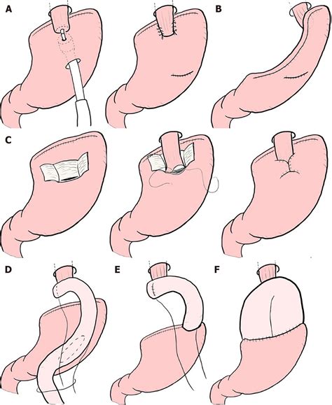 Precision Surgical Approach With Lymph Node Dissection In Early Gastric Cancer