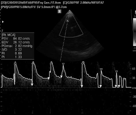 Transcranial Doppler Flow Velocity Pattern Cms In The Right Mca
