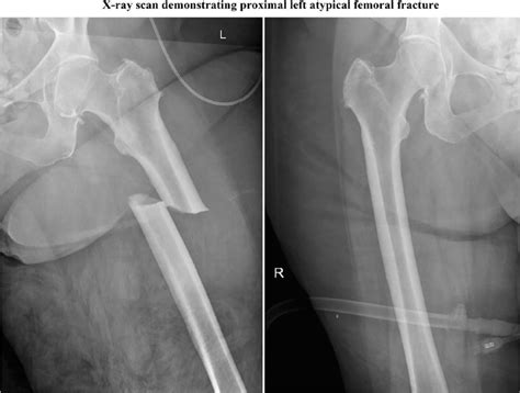 Frontal Projection X Ray Of Left Femur Left Image Demonstrates Download Scientific Diagram