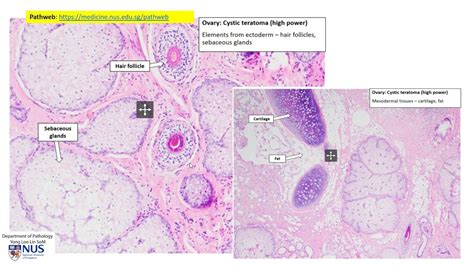 Teratoma Histology