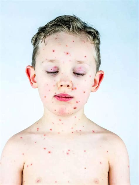 தக்காளி காய்ச்சல் என்றால் என்ன இதன் அறிகுறிகள் என்னென்ன Tamilsamayam