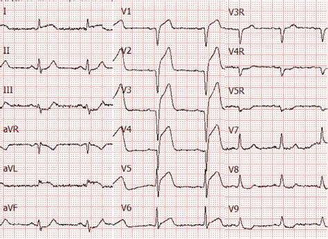 Electrocardiogram Of Patients With Anterolateral Wall Myocardial Download Scientific Diagram