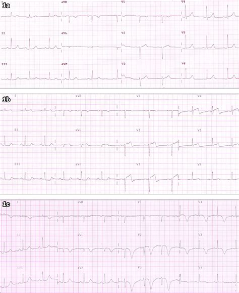 Serial ECGs Show A An Initially Normal ECG B Anterior ST Segment Download Scientific