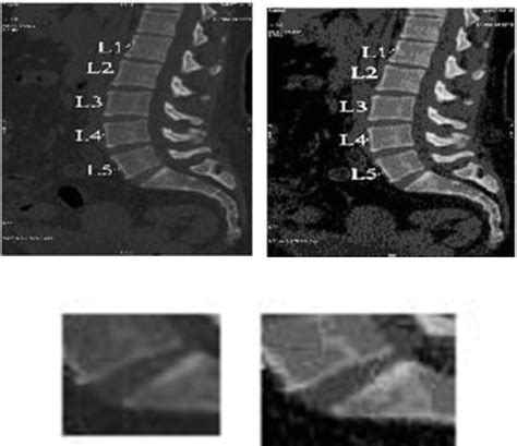 Figure 1 From Kernel Based Fcm For Spinal Cord Segmentation On Computed Tomography Images