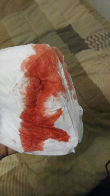 Implantation Bleeding Brown And Pink