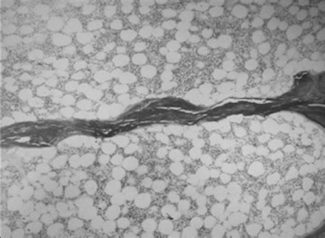 Adynamic Bone Disease In An Esrd Patient An Isolated Trabecula Among A Download Scientific