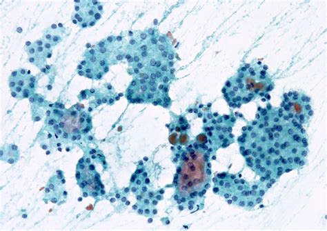 What Is Atypical Follicular Cells Of Thyroid