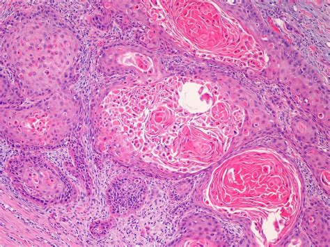 High Power H And E Stain Vulvar Tumor Showing High Grade Squamous Cell