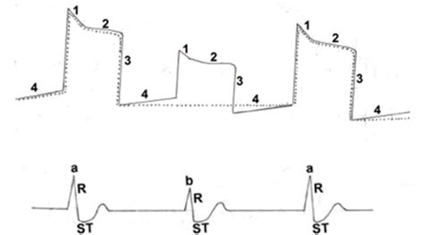 Qrs Alternans During Treadmill Testing In A Case Of Angina Biores