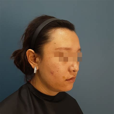 보톡스전후사진 다이브클리닉