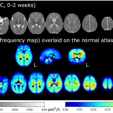 Statistical Lesion Atlas Quantifying The Voxel Wise Lesion Frequency In Download Scientific