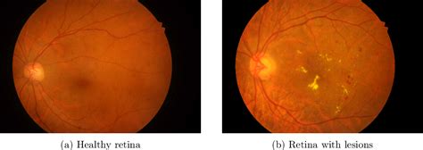 Figure 11 From Retinal Lesions Segmentation Using Cnns And Adversarial Training Semantic Scholar