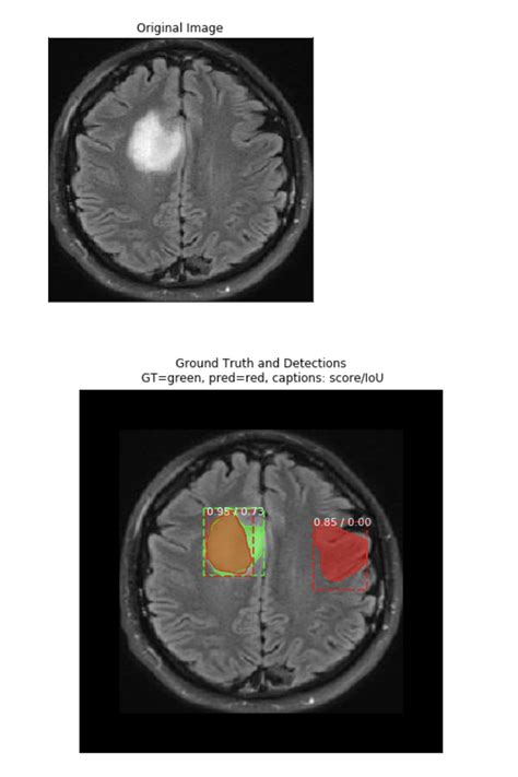Brainscan Tumour Detector Devpost