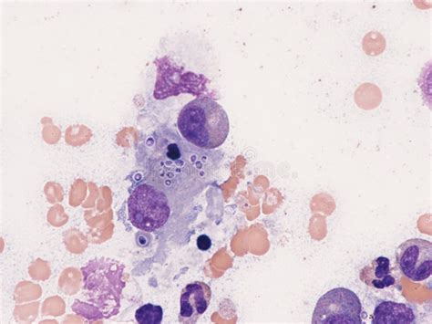 Histoplasma Capsulatum In Bone Marrow Stock Image Image Of