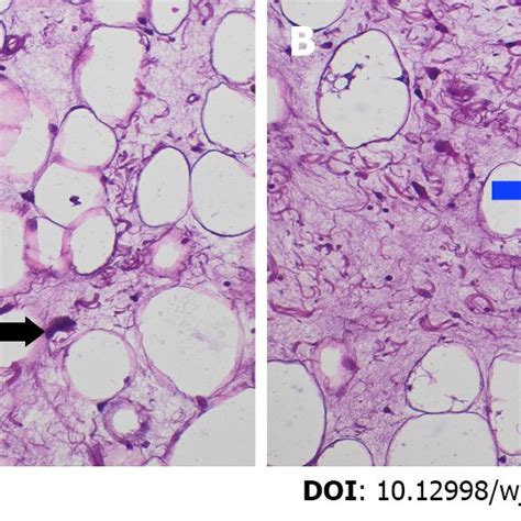 Pathologic Picture Of Well Differentiated Liposarcoma A Atypical Download Scientific Diagram