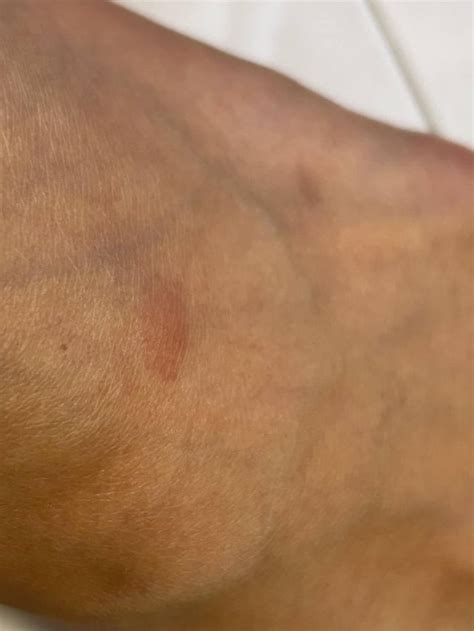 Red Spots On Legankles Rdermatologyquestions