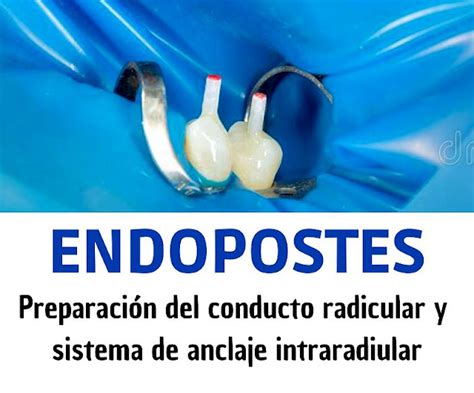 Endopostes Preparación Del Conducto Radicular Y Sistema De Anclaje