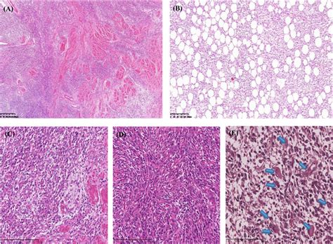 Morphologic Features Of The Low‐grade Endometrial Stromal Sarcoma On Download Scientific