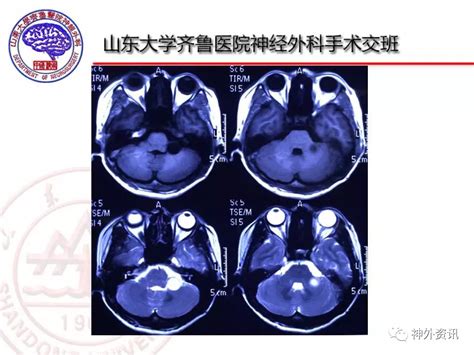 乙状窦后入路无血快速开关颅技术标准化操作流程（sop） 脑医汇 神外资讯 神介资讯
