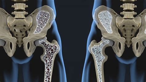 Bone Mineral Densitometry DEXA Exact Radiology