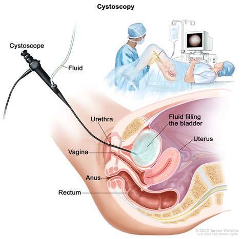 Bladder Cancer Screening NCI