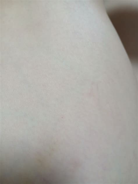 피부에 바늘로 콕 찍은듯한 붉은점과 붉은 발진 지식in