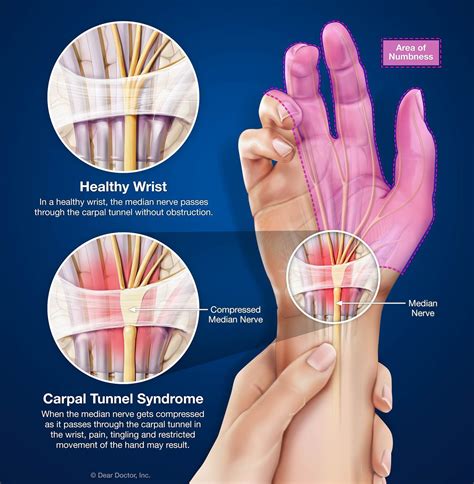 Median Nerve Carpal Tunnel