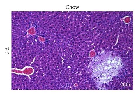 Cholesterol Overload Exacerbates Liver Tissue Damage Histology