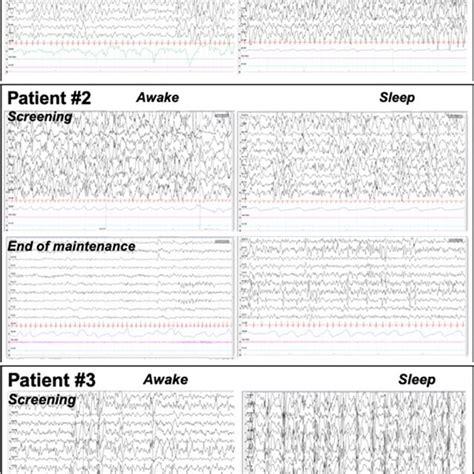 Interictal Eeg Recordings Of The Patients At Baseline And At The End Of Download Scientific