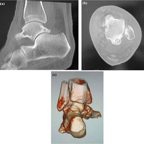 Photograph Of The Resected Enlarged Posterior Talar Process 18 Mm In Download Scientific