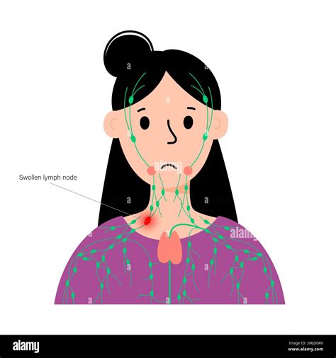 Swollen Cervical Lymph Nodes