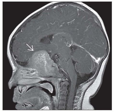 Peripheral Primitive Neuroectodermal Tumor Ewing Sarcoma