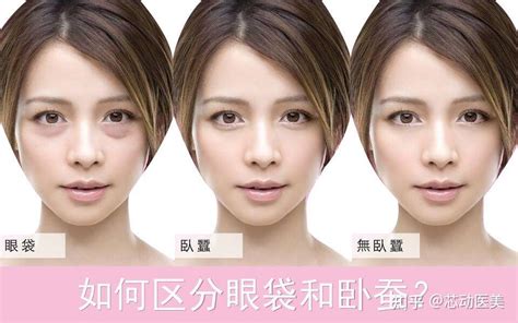怎么区分卧蚕和眼袋眼袋是如何形成的 知乎