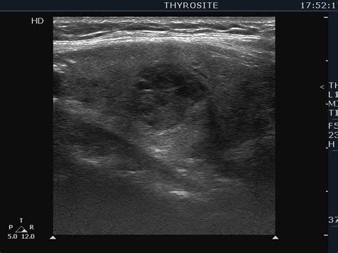 The Echogenicity Of The Nodule