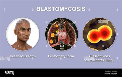 3d Illustration Showing Two Clinical Presentations Of Blastomycosis And