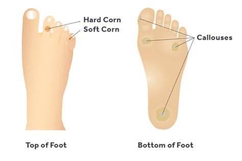 Corns And Calluses Foot Conditions We Treat In Melbourne Hurst Podiatry