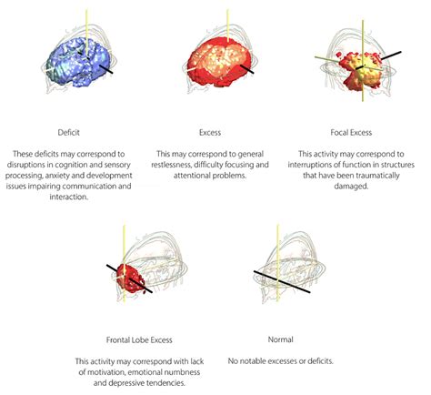 Eeg Images Brain Treatment Columbus And Cincinnati