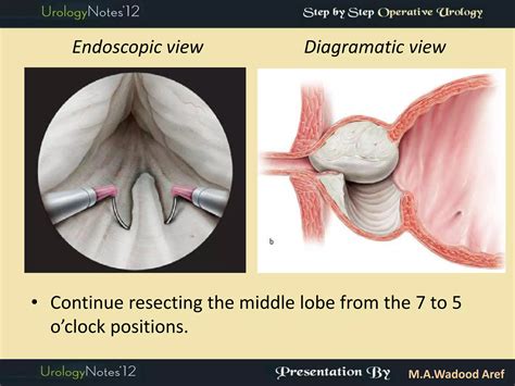 Turp Step By Step Operative Urology Pdf