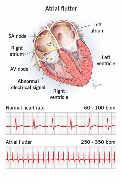 Atrial Flutter Symptoms And Treatment Wockr