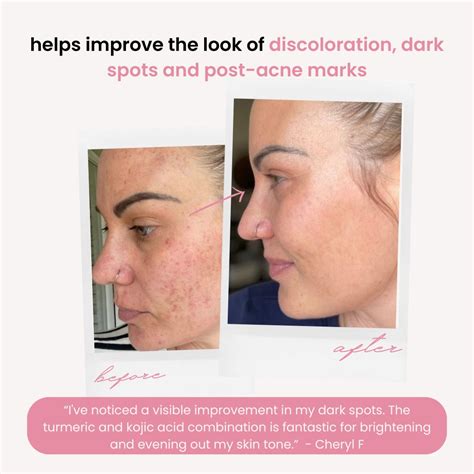 Turmeric Kojic Acid Pads Timibee