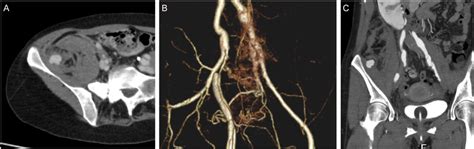 Contrast Enhanced Computed Tomography Shows The Retroperitoneal