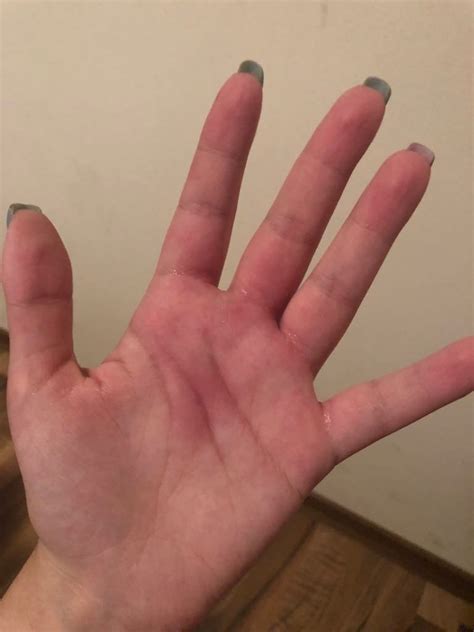 Червени болезнени петна по тялото Здравословни проблеми Мнения от Bg Mamma