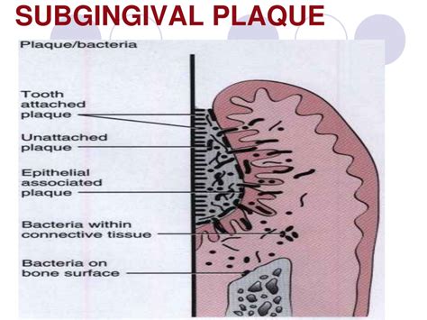 Plaque Bacteria Species At Richard Rentas Blog